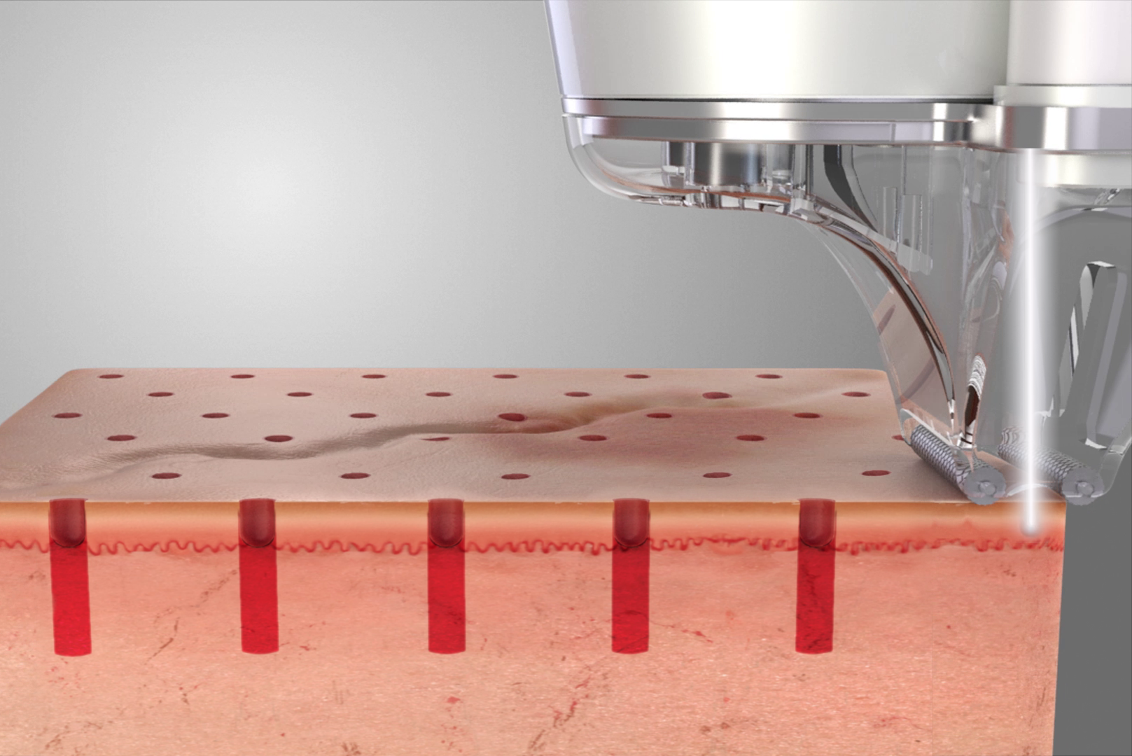 Sciton | Choosing the Best Laser for Skin Resurfacing